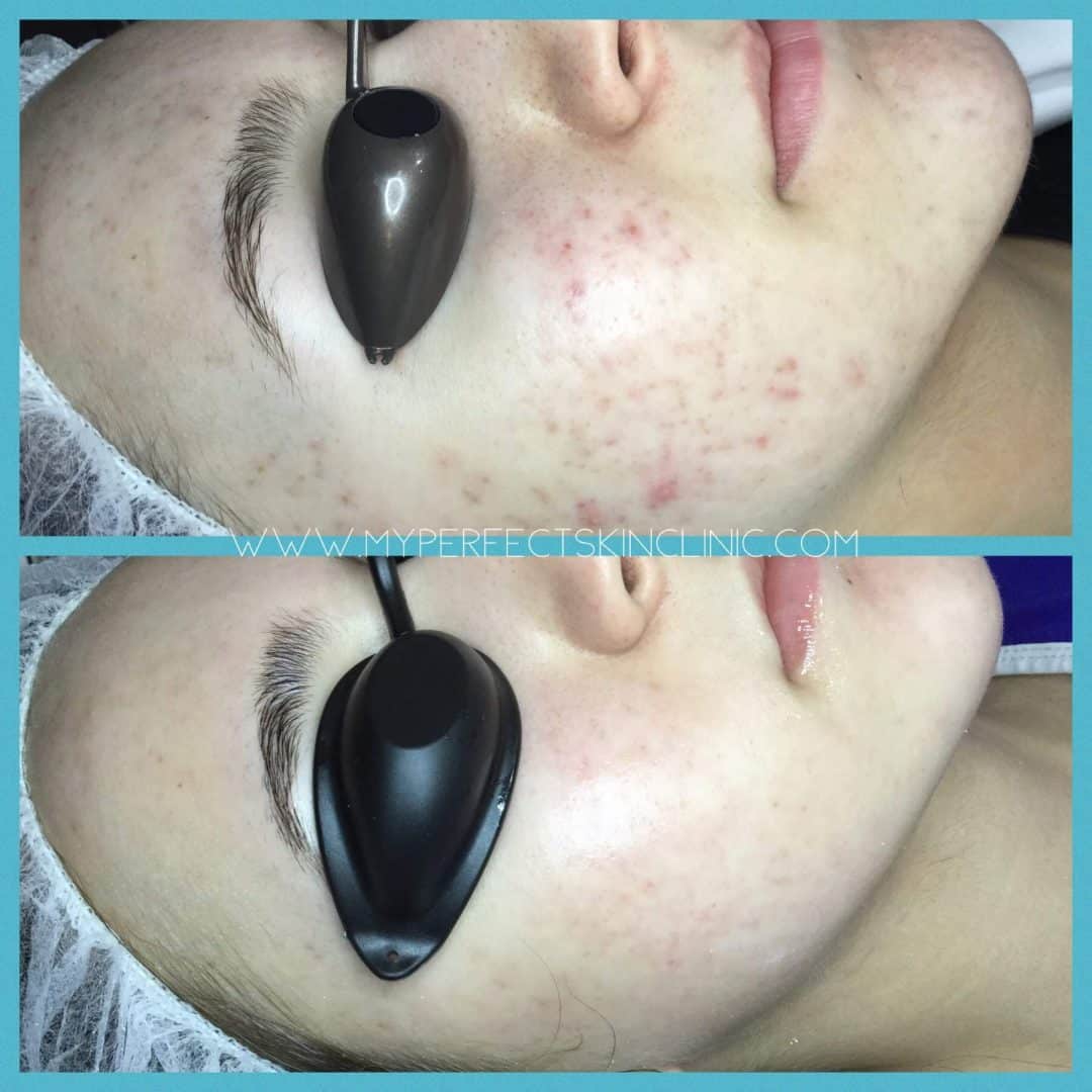 Microneedling Treatments in Gilbert AZ