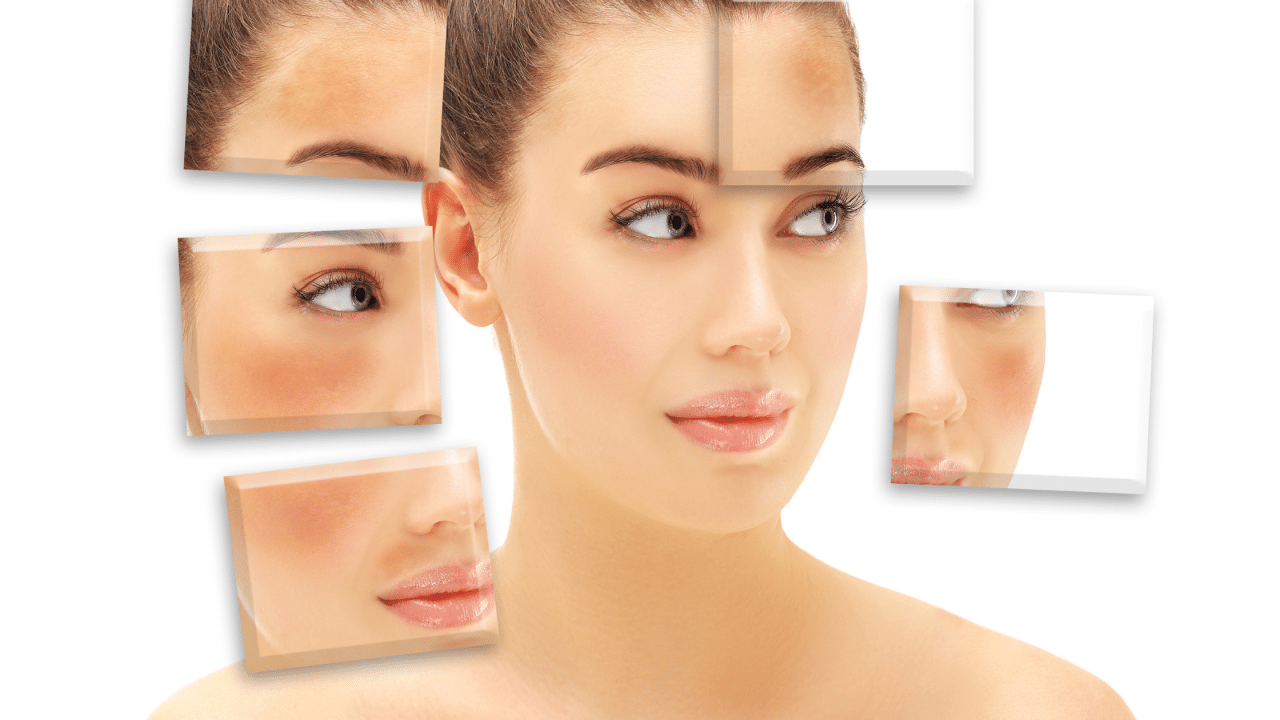 Hyperpigmentation Causes and treatments - My Perfect Skin Clinic