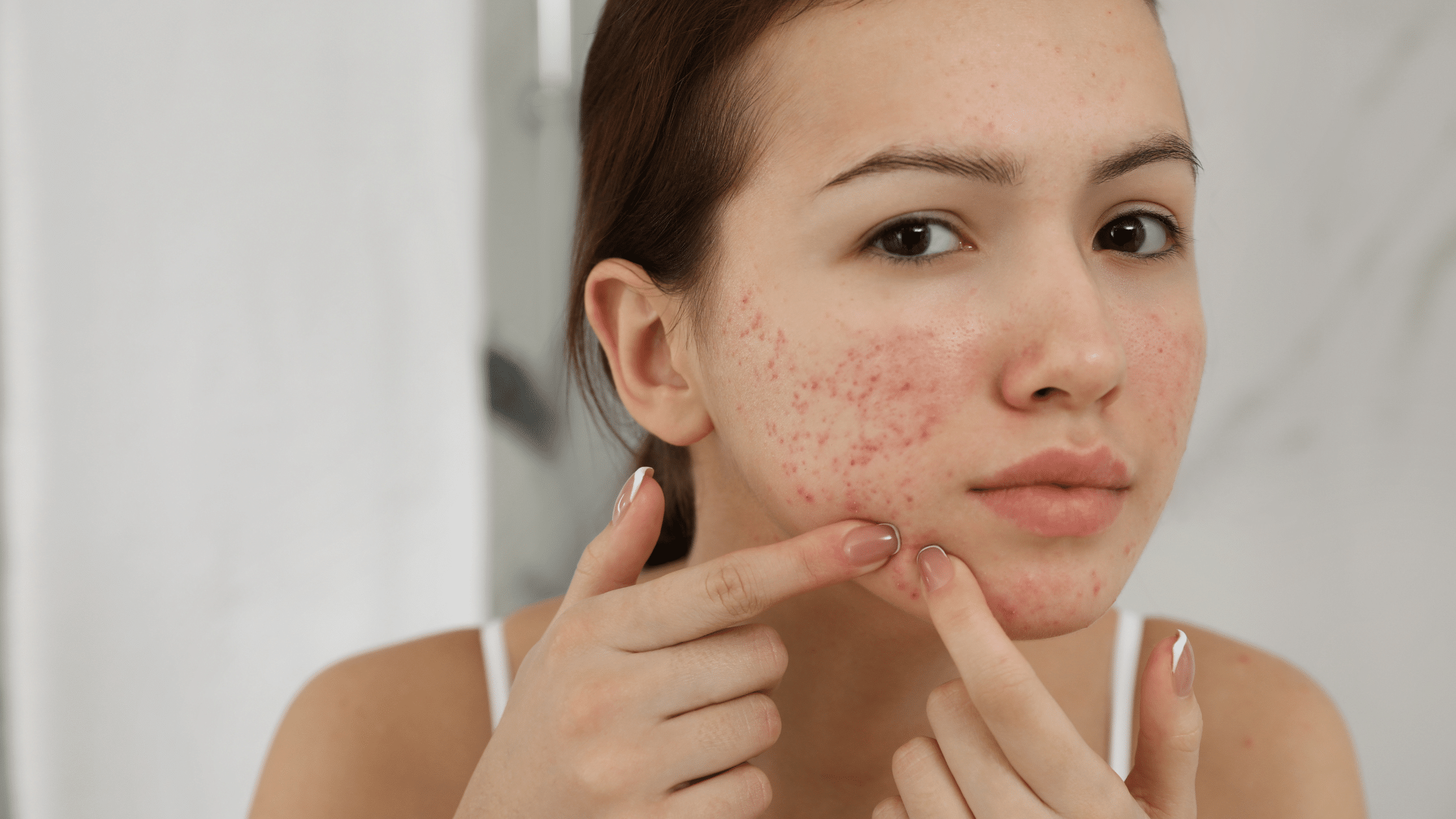 Acne and Scar Basics - My Perfect Skin Clinic